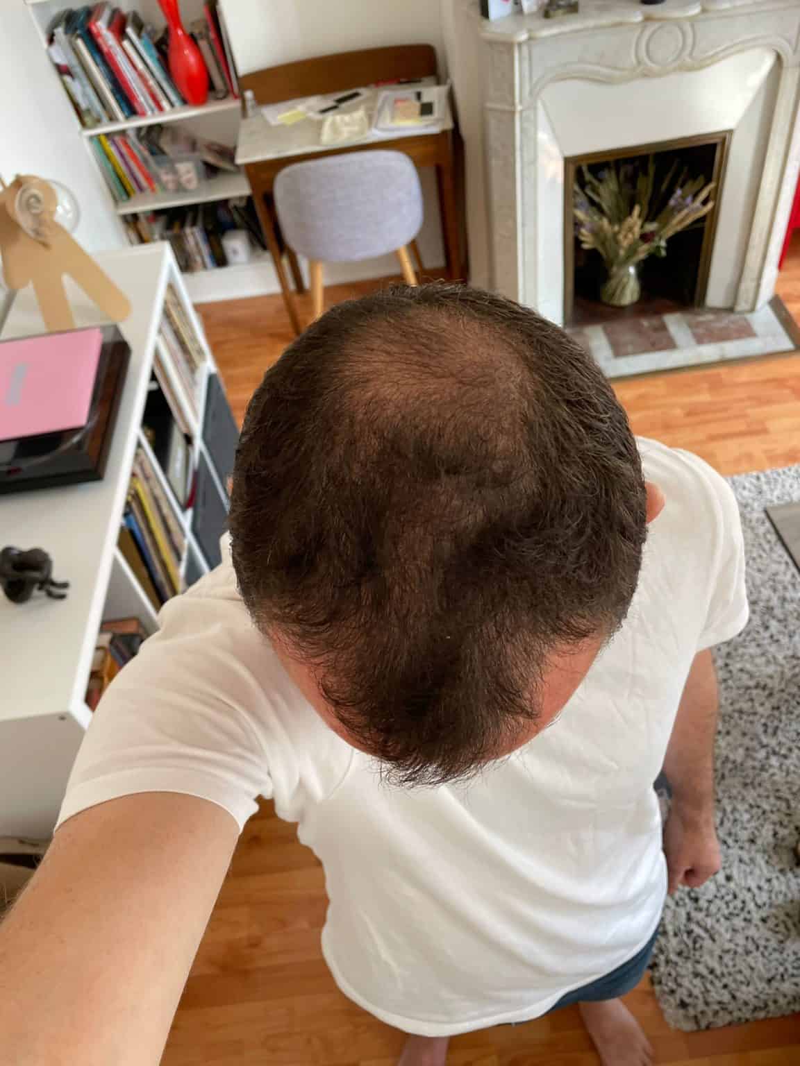 Résultat de Greffe de Cheveux Mois par Mois, Le Guide Ultime