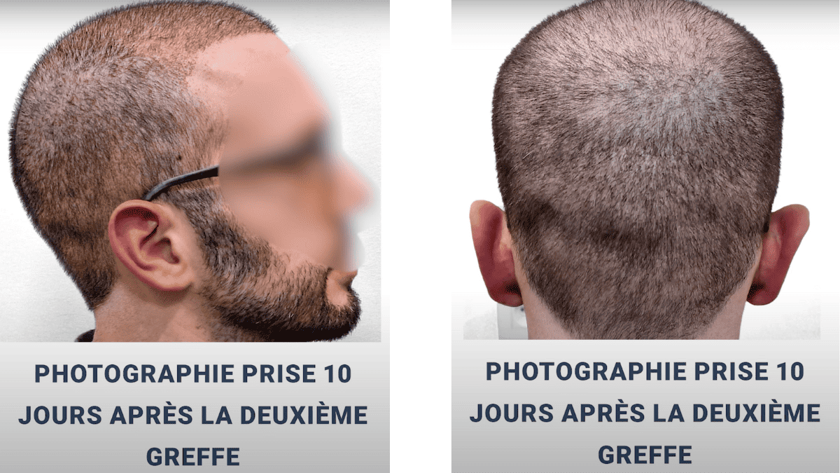 Greffe de cheveux ratée : comment la réparer
