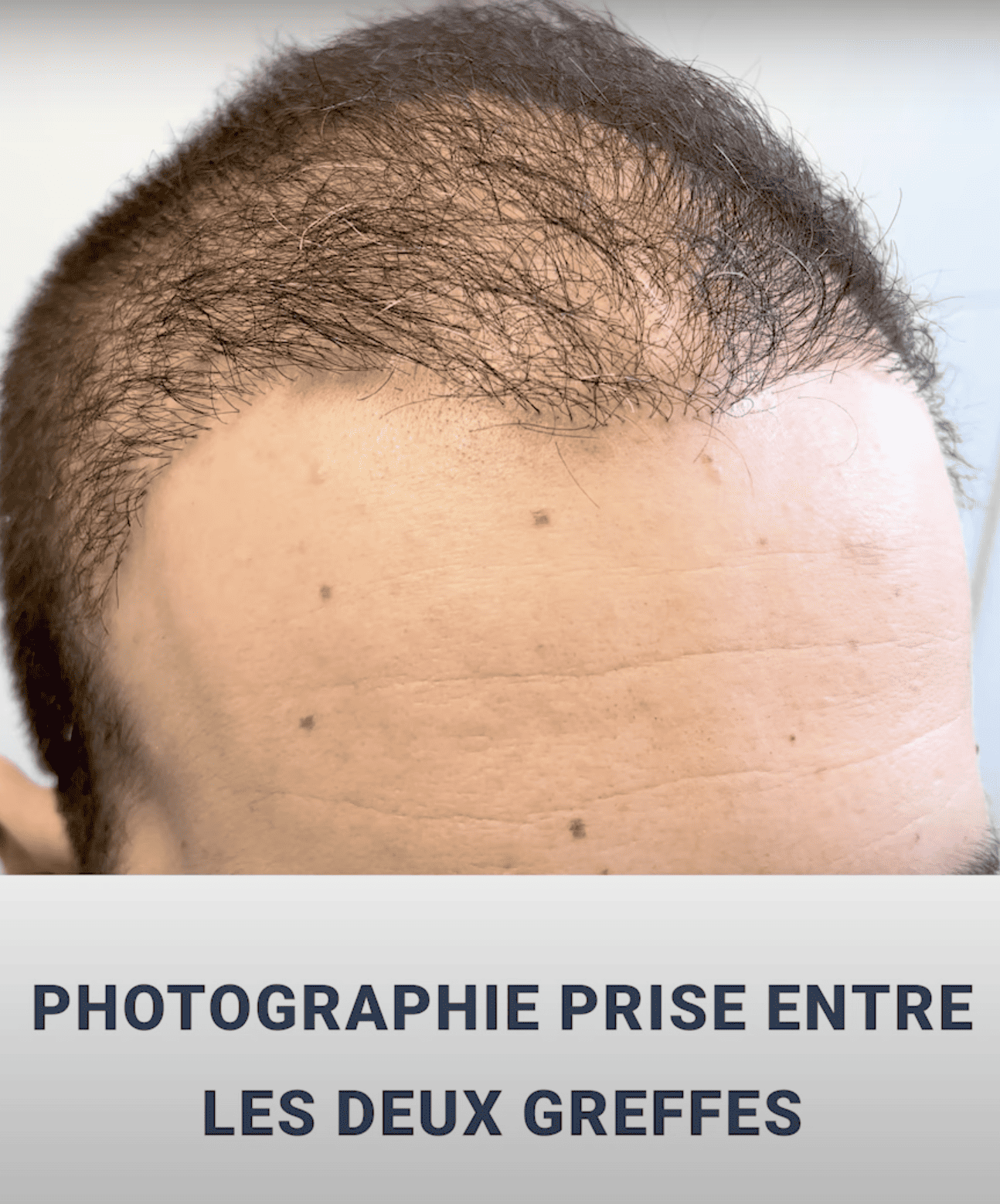 Greffe de cheveux ratée : comment la réparer